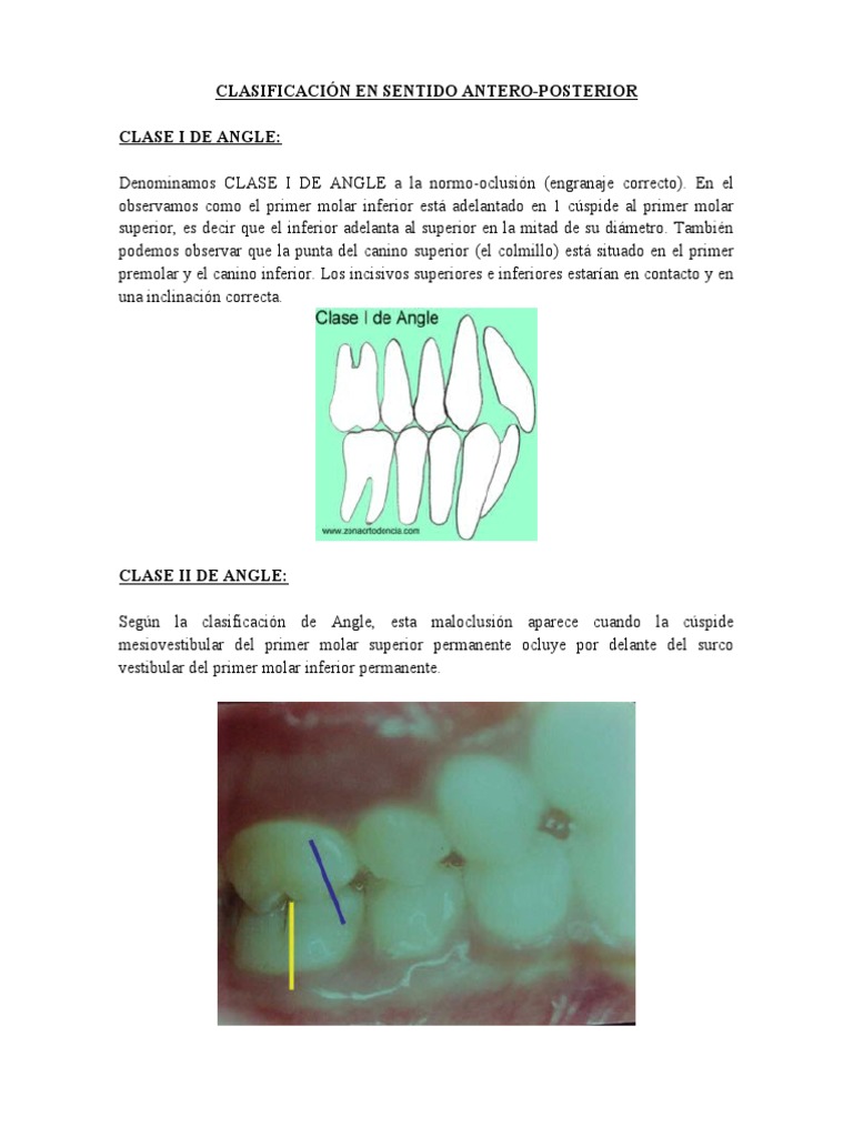 Alexander Chavez Butron - Clase Ii de Angle | PDF | Anatomia dental | Boca