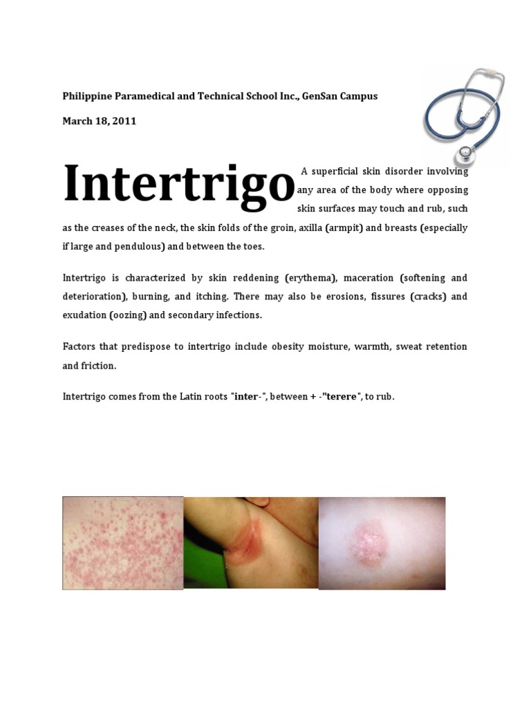Intertrigo: Philippine Paramedical and Technical School Inc., Gensan ...