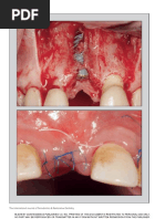 Perio-Prosthodontic Pontic Site Management, Part I: Pontic Designs and ...