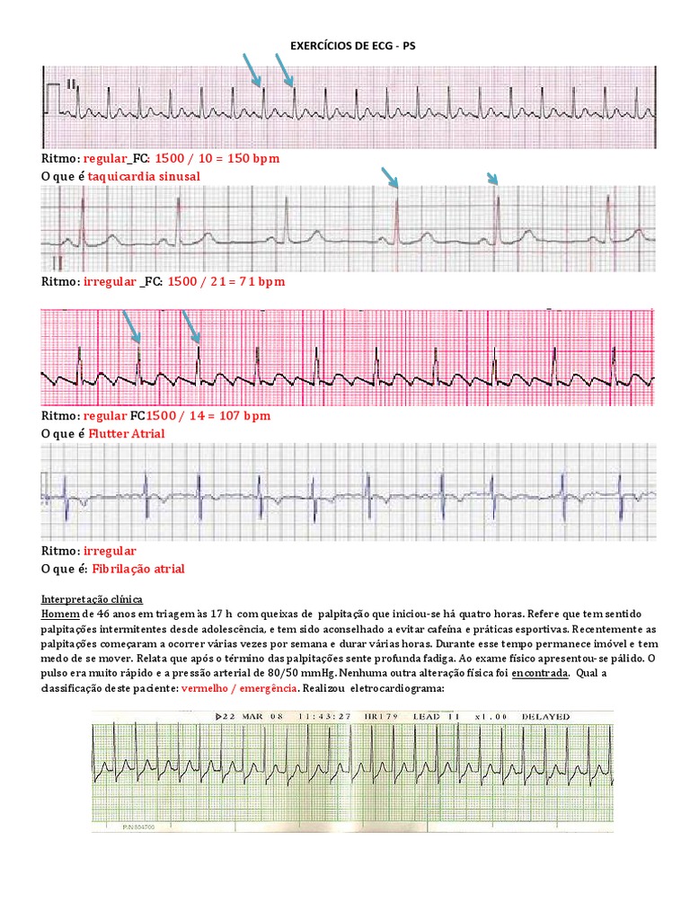 ECG Exercises - Interpretation and Treatment | PDF | Eletrocardiografia ...