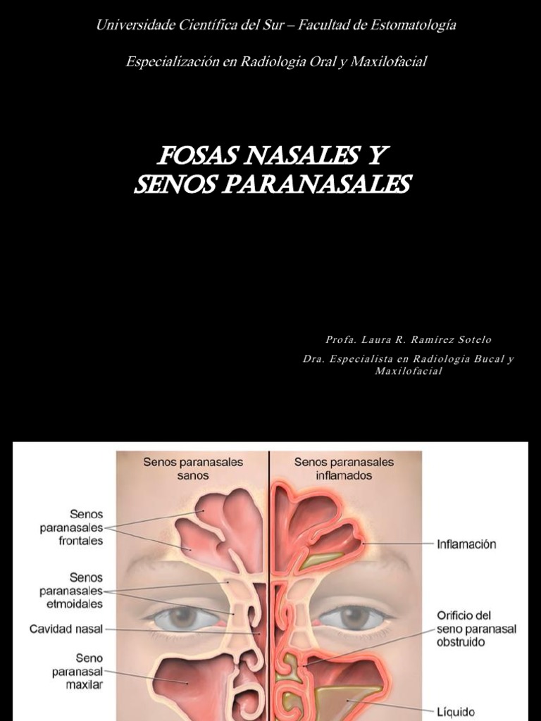 Anatomía Del Seno Etmoidal