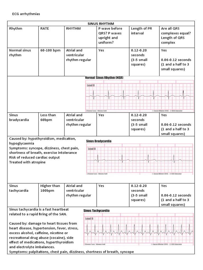 ECG Arrhythmias | PDF | Heart | Electrocardiography