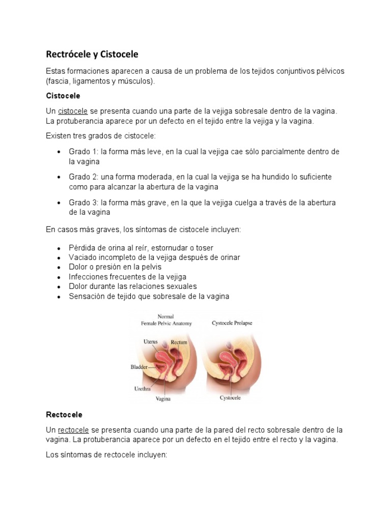 Cistocele y Rectocele: Síntomas y Tratamientos | PDF | Vagina ...