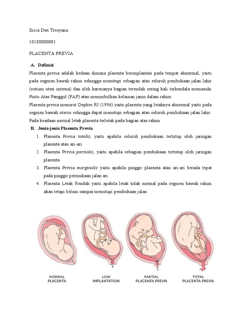 Sisca Dwi Tresyana Placenta Previa Dan Solusio Plasenta | PDF