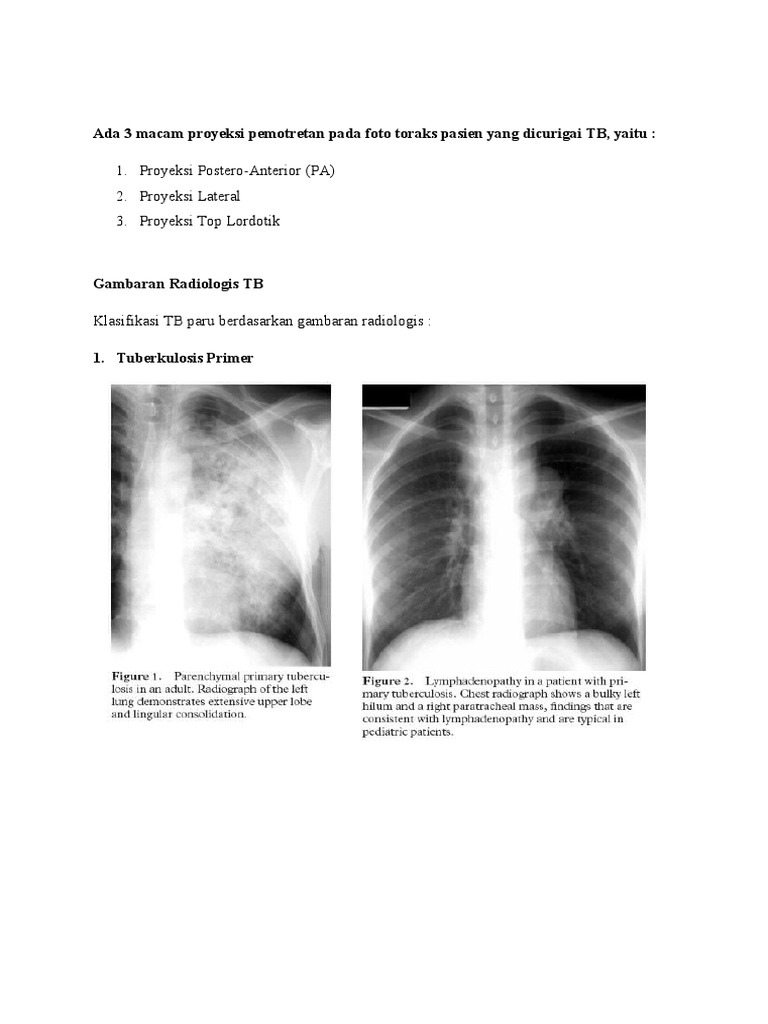 TB Pada Orng Dewasa | PDF | Ilmu Sosial