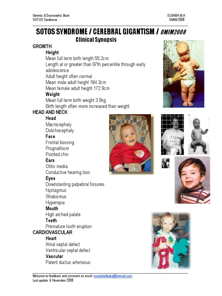Sotos Syndrome / Cerebral Gigantism /: Clinical Synopsis | PDF ...
