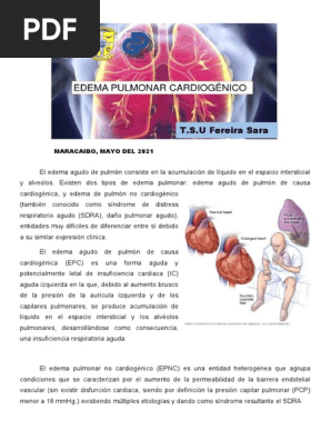 Signos Y Sintomas De Edema Pulmonar