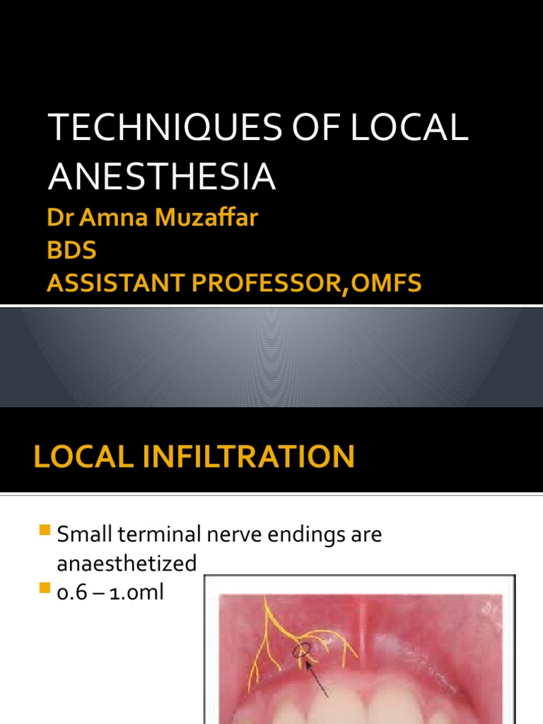 Techniques of Local Anesthesia: DR Amna Muzaffar BDS Assistant ...
