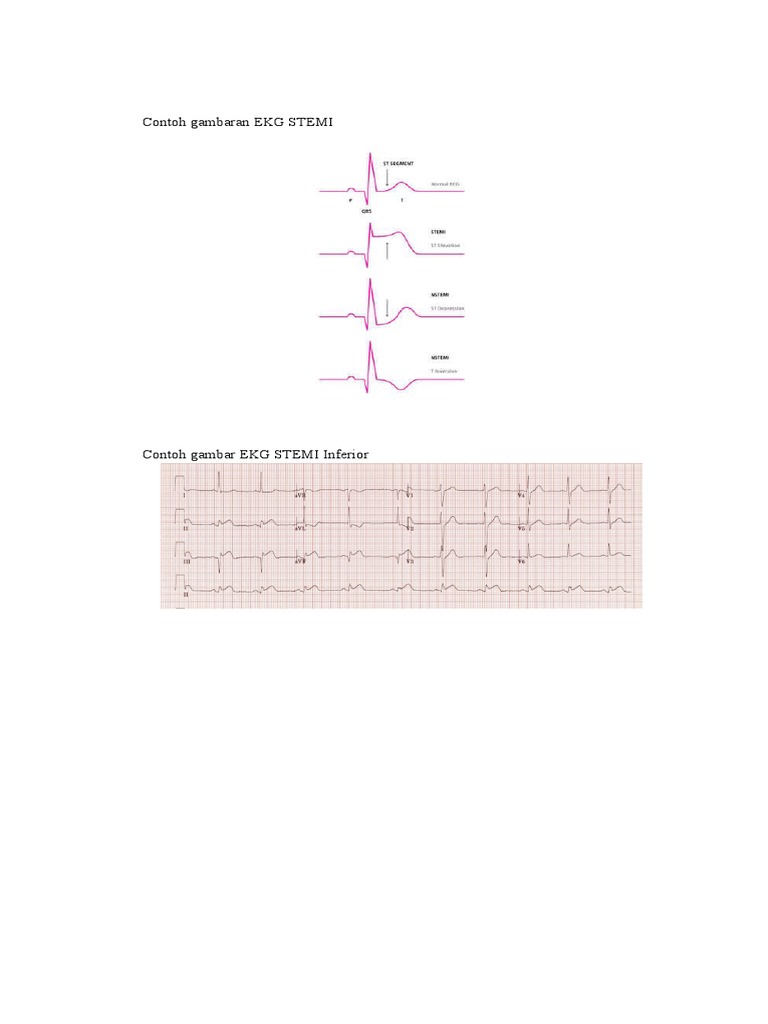 Contoh Gambaran EKG STEMI | PDF