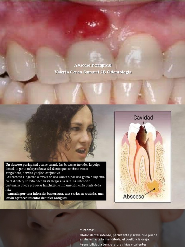 Absceso Periapical 1 | PDF