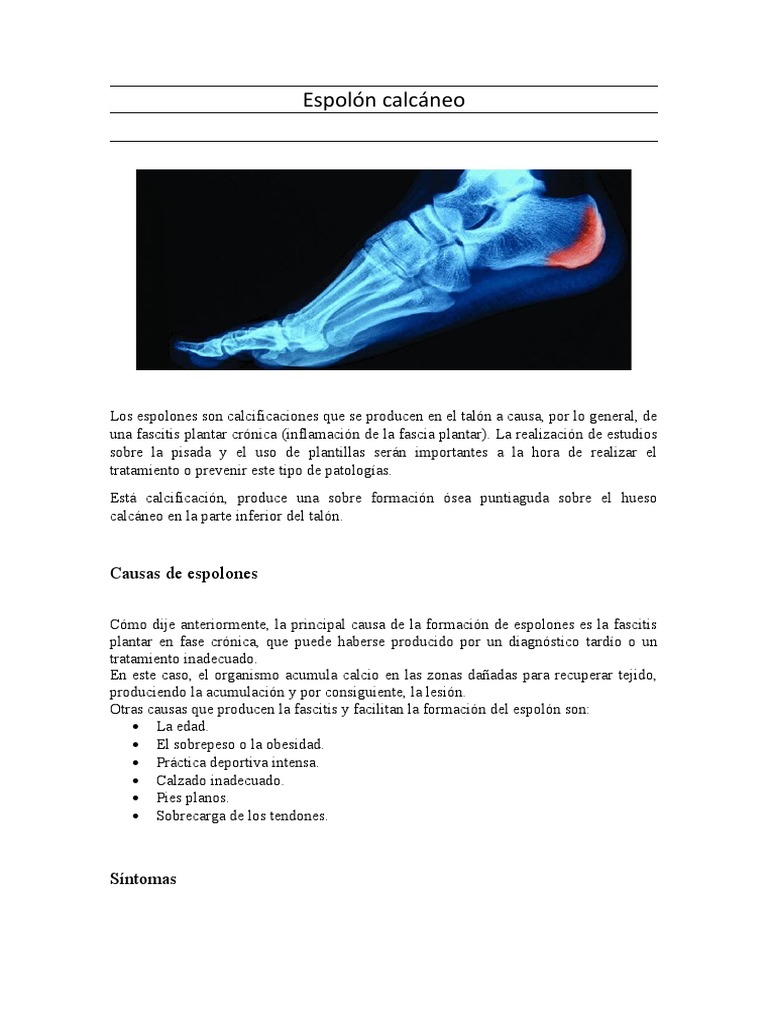 TP Espolón Calcáneo | PDF | Pie | Artritis Reumatoide