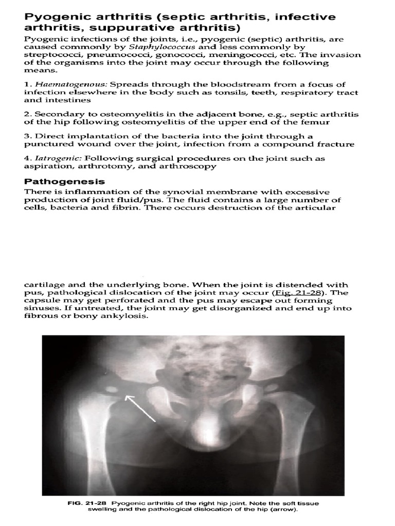 Arthritis, Suppurative Arthritis) : Pyogenic Arthritis (Septic ...