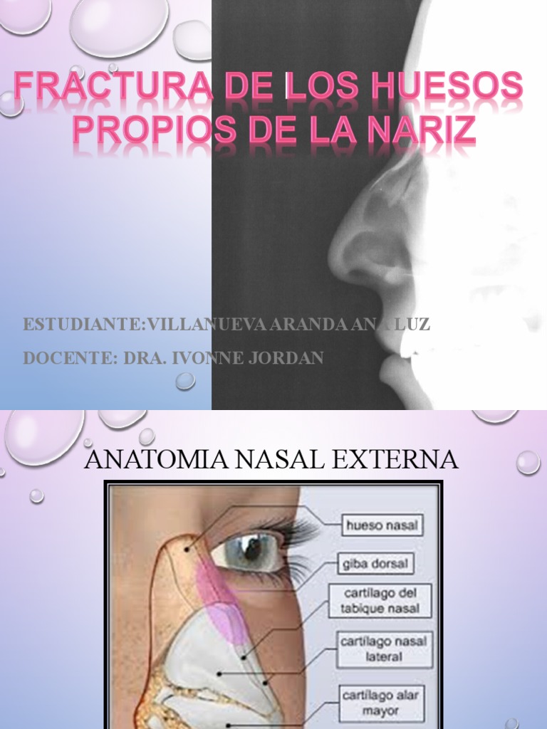 Fracturas Nasales: Anatomía y Clasificación | PDF | Hueso | Anatomía
