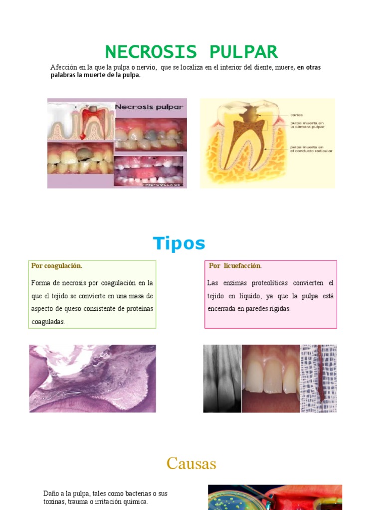Necrosis Pulpar | PDF