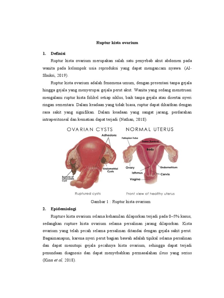 Ruptur Kista Ovarium: Gejala dan Penanganan | PDF