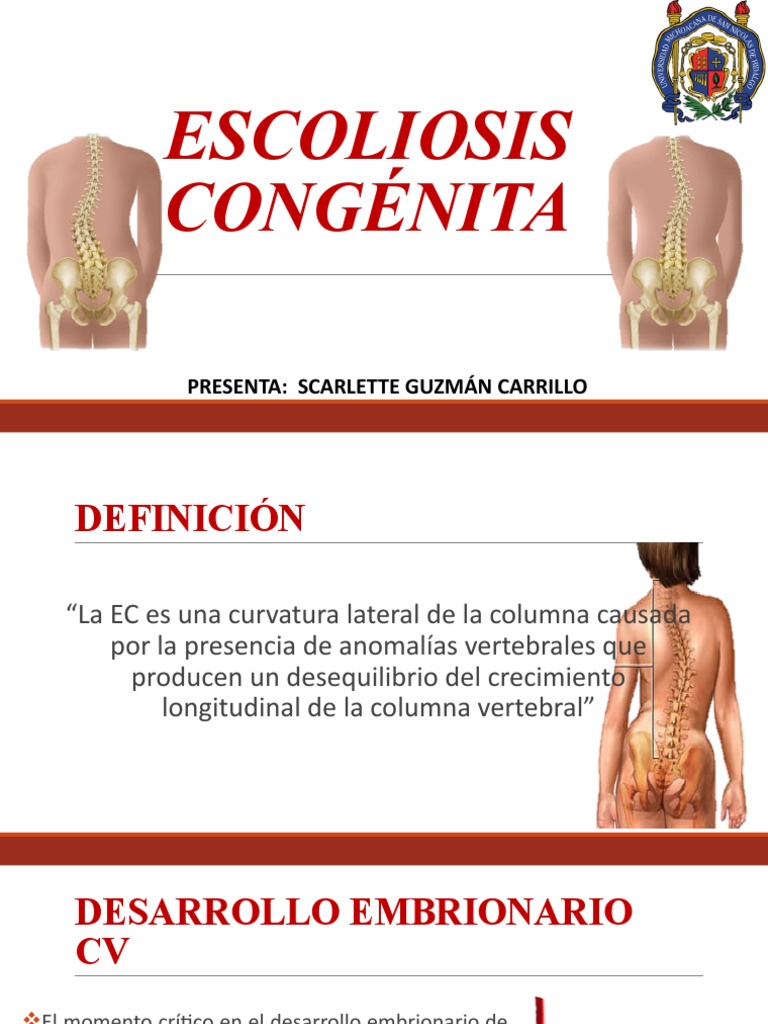 Escoliosis Congénita | PDF | Escoliosis | Especialidades Medicas