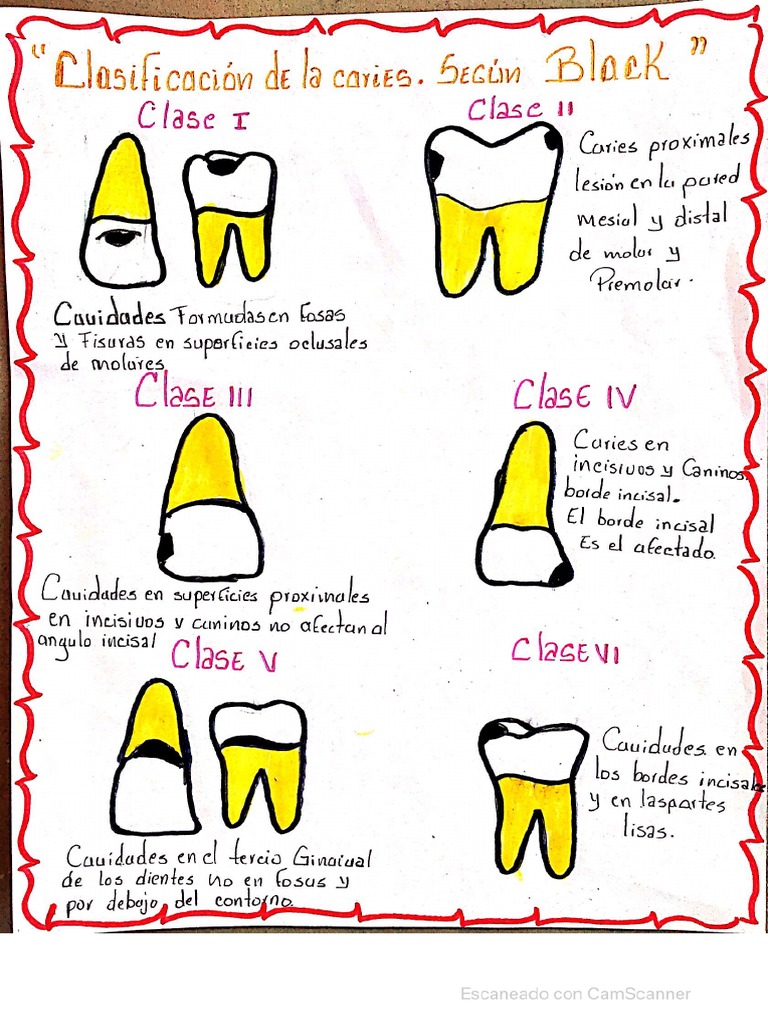 Clasificación de Las Caries Según Black | PDF