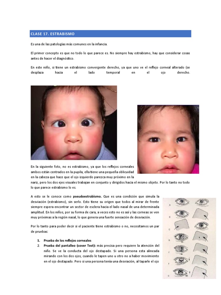 Estrabismo Infantil: Diagnóstico y Tratamiento | PDF | Percepción ...