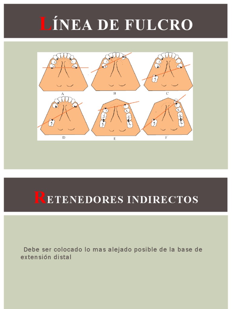 3° Retenedores, Linea de Fulcro | PDF