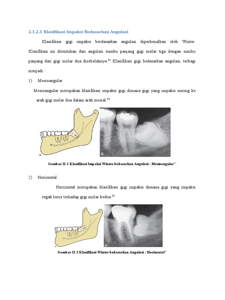 2.1.2.1 Klasifikasi Impaksi Bedasarkan Angulasi | PDF | Sains & Matematika
