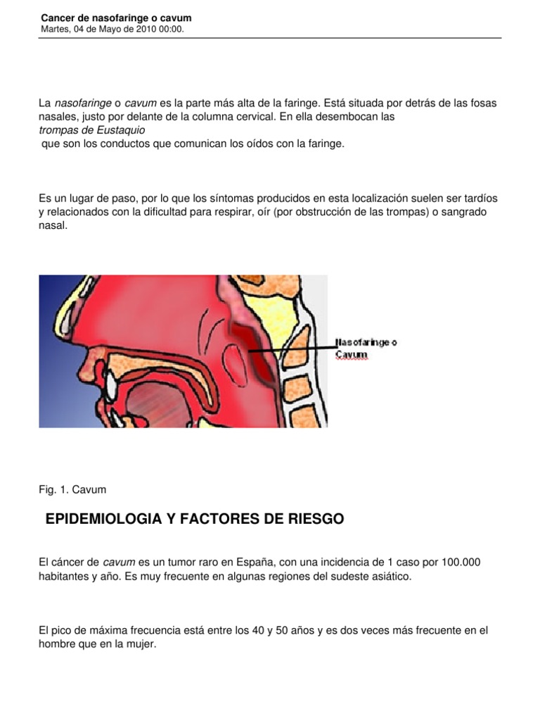 1139 Cancer de Nasofaringe o Cavum | PDF | Cáncer | Quimioterapia