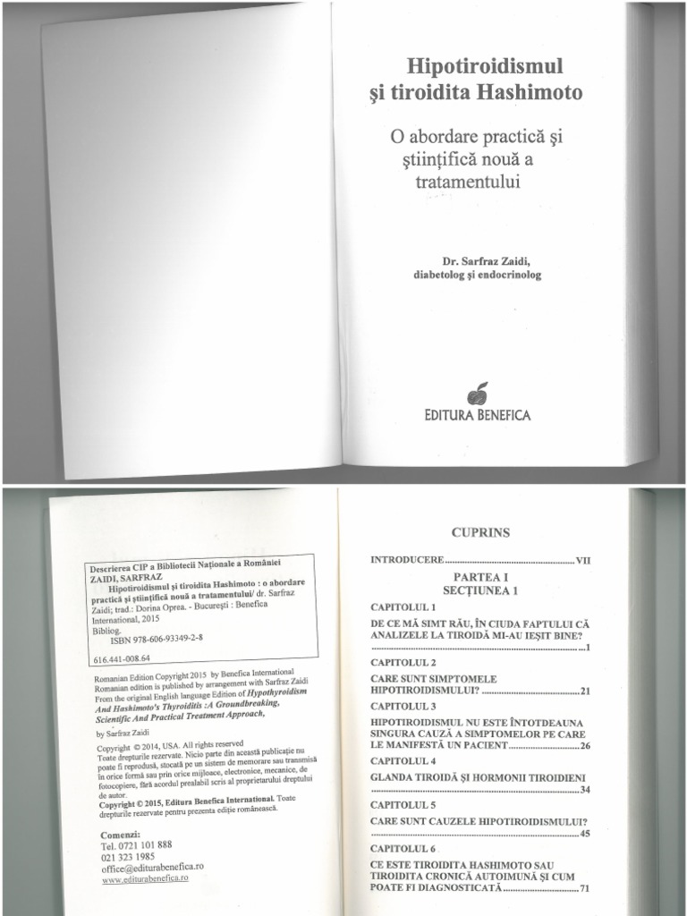 Hipotiroidismul Si Tiroidita Hasimoto | PDF