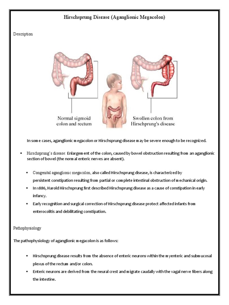 Hirschsprung Disease (Aganglionic Megacolon) | PDF | Medical ...