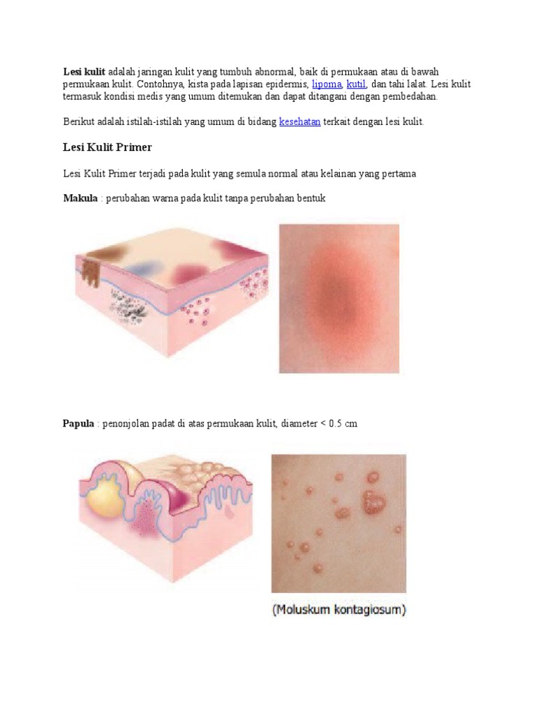 Lesi Kulit Adalah Jaringan Kulit Yang Tumbuh Abnormal | PDF