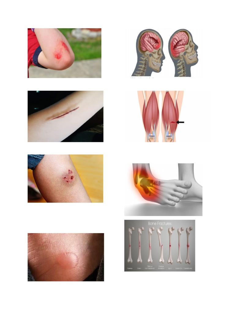 Different Injuries | PDF | Bone | Musculoskeletal System
