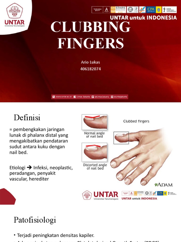 Clubbing Fingers | PDF