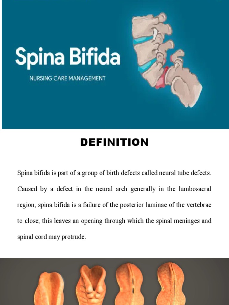 Spina Bifida | PDF | Vertebral Column | Human Diseases And Disorders