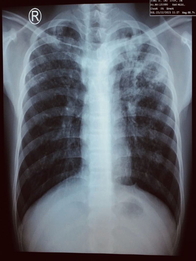 Latihan Kasus Foto Thorax 2 | PDF