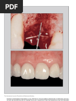 Maxillary Injections Cheat Sheet | PDF | Dentistry | Dentistry Branches