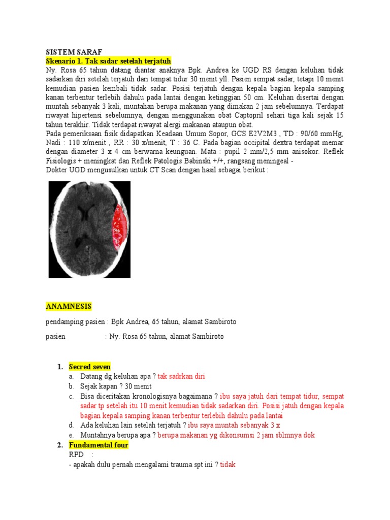 Sken 1 - Epidural Hematoma | PDF
