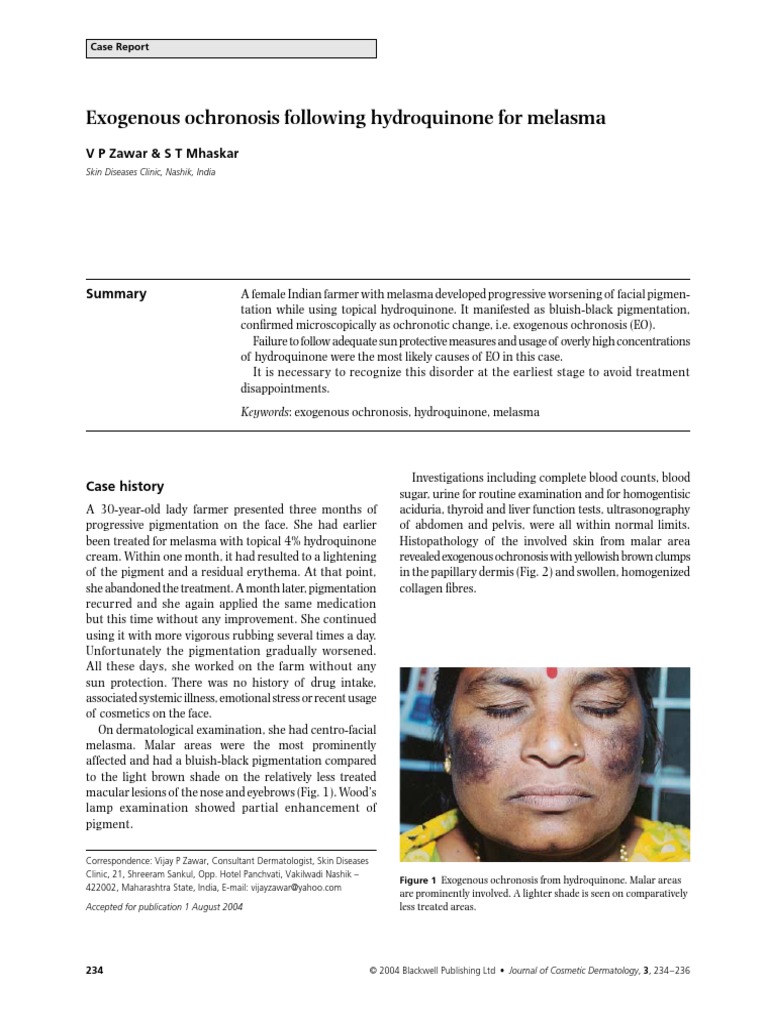 Exogenous Ochronosis Following Hydroquinone For Melasma: V P Zawar & S ...