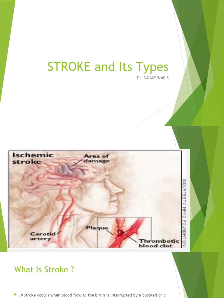 Understanding Stroke: Types, Causes, Symptoms, Treatment and ...