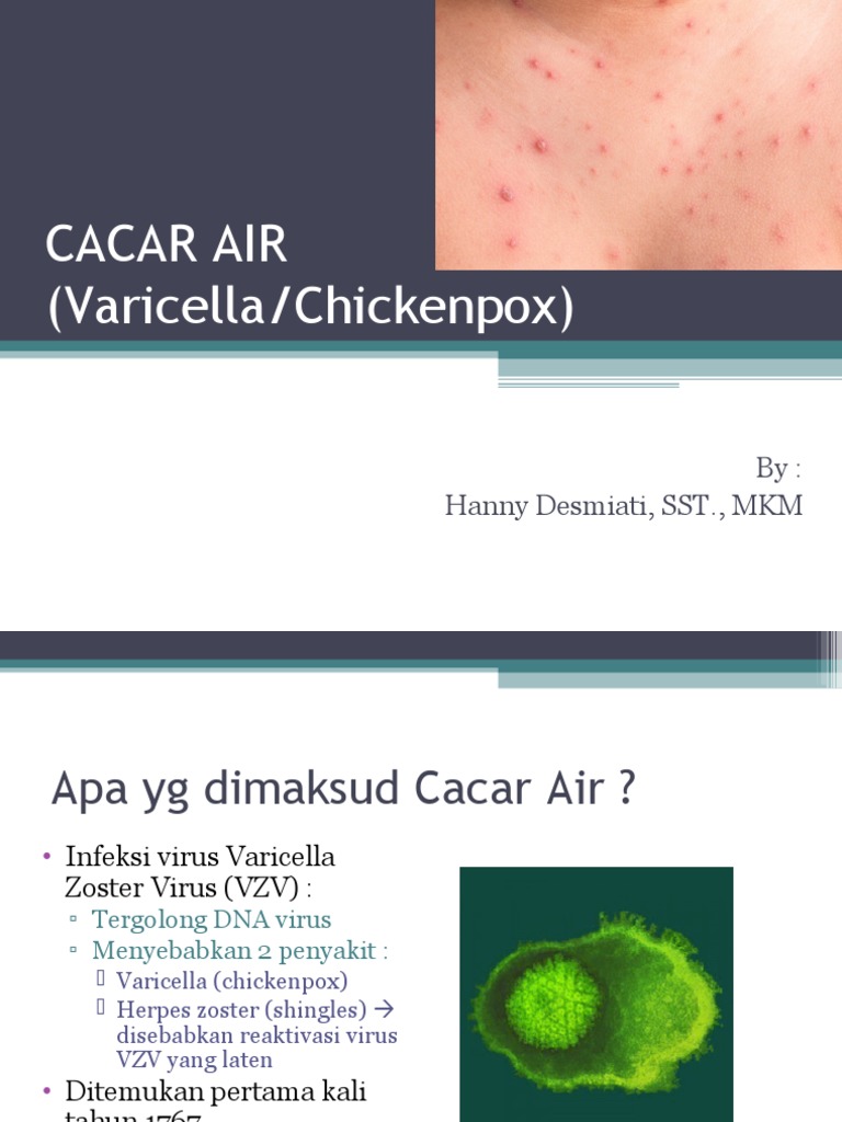 Cacar Air | PDF