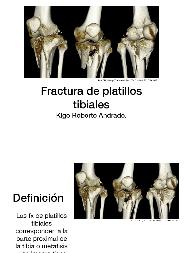 Fractura de Platillos Tibiales. | PDF