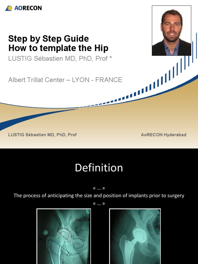 Step by Step Guide How To Template The Hip: Lustig Sébastien MD, PHD ...