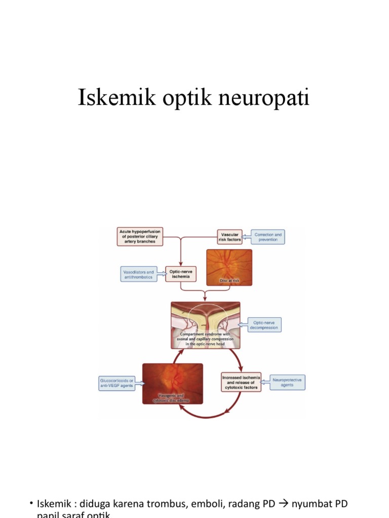 Iskemik Optik Neuropati | PDF