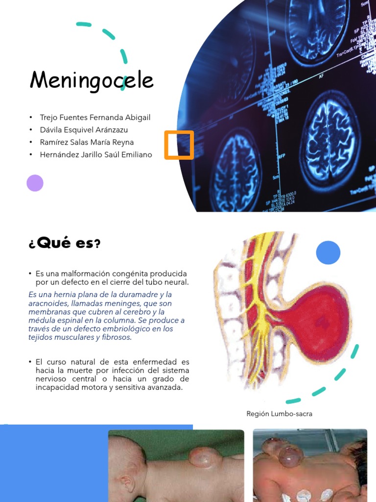 Equipo 4 Meningocele | PDF | Especialidades Medicas | Medicina CLINICA