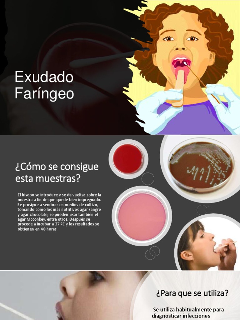 Exudado Faríngeo | PDF | Estreptococo | Especialidades Medicas