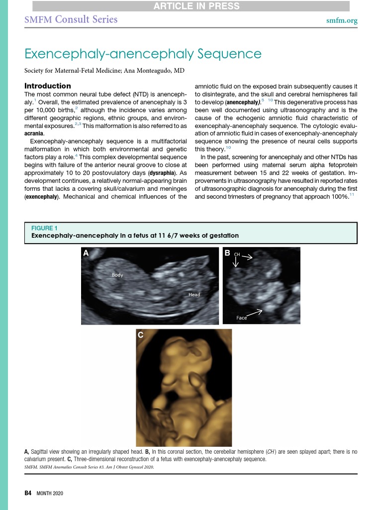 Exencephaly-Anencephaly Sequence: Consult Series | PDF | Genetic ...
