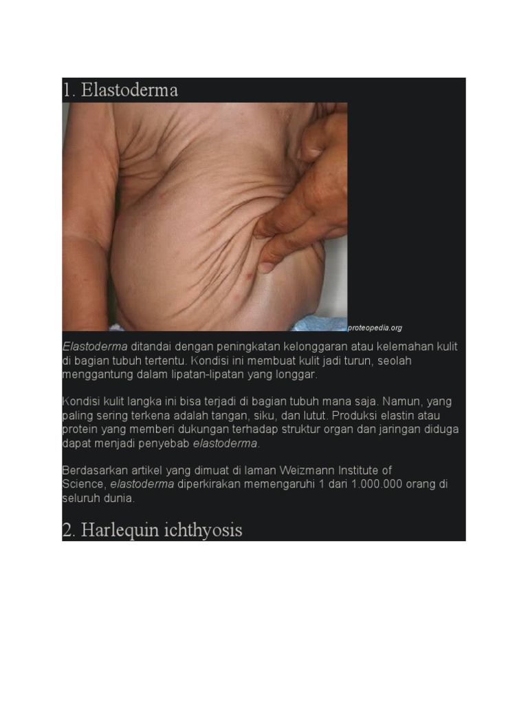 Elastoderma Elastoderma Ditandai Dengan Peningkatan Kelonggaran Atau Kelemahan Kulit Pdf