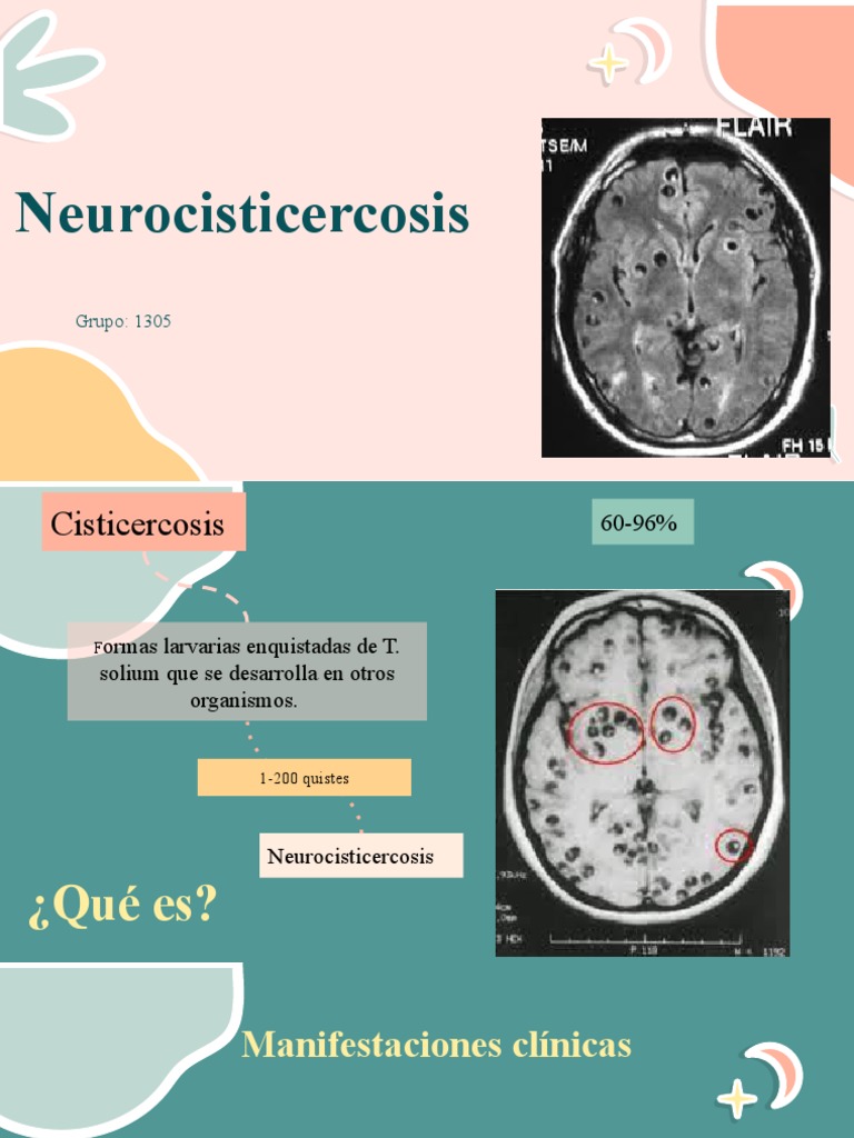 Diagnostico de Neurocisticercosis | PDF | Medicina CLINICA ...