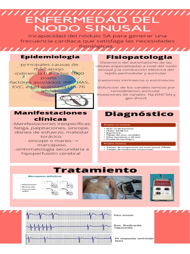 Enfermedad Del Nodo Sinusal INFO | PDF