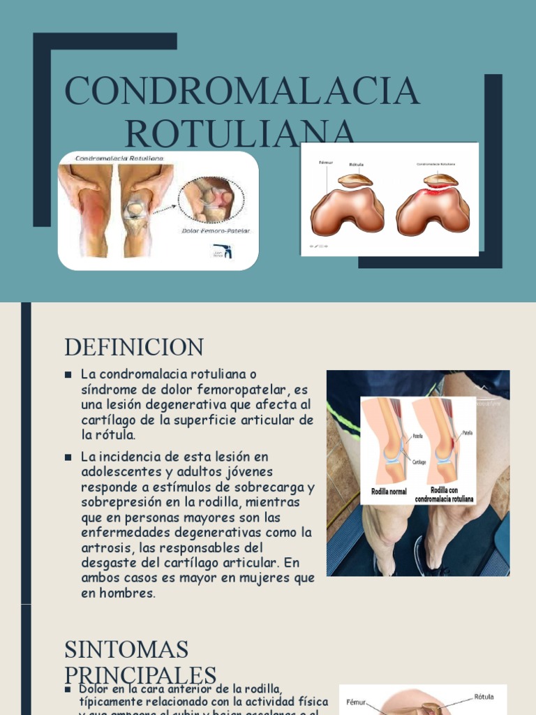 Condromalacia Rotuliana: Síntomas y Tratamiento | PDF | Rodilla ...