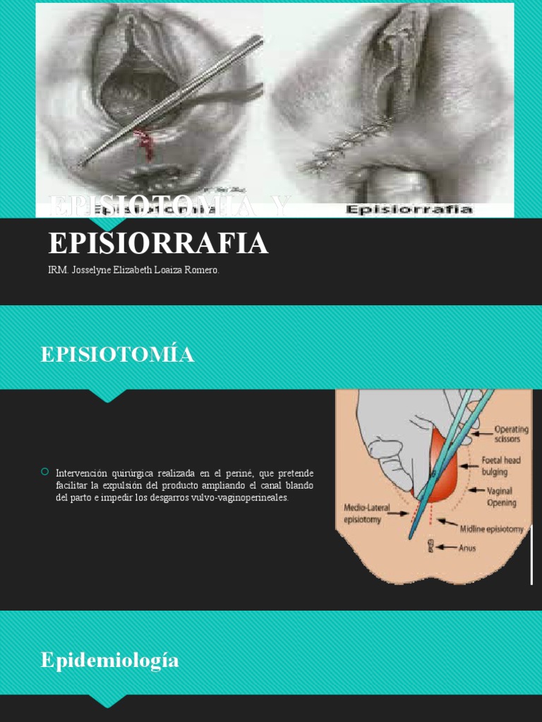 Guía de Episiotomía y Episiorrafia | PDF | Parto | Especialidades Medicas