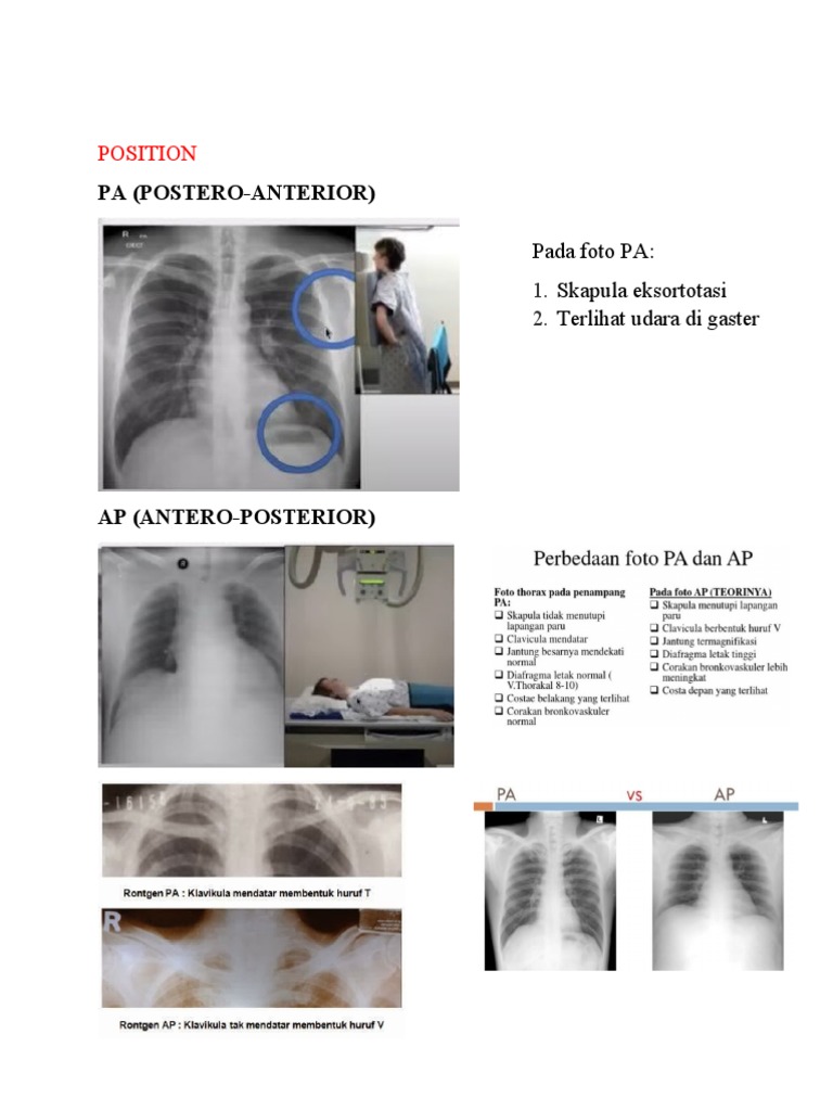 Perbedaan Rontgen Thorax AP dan PA | PDF