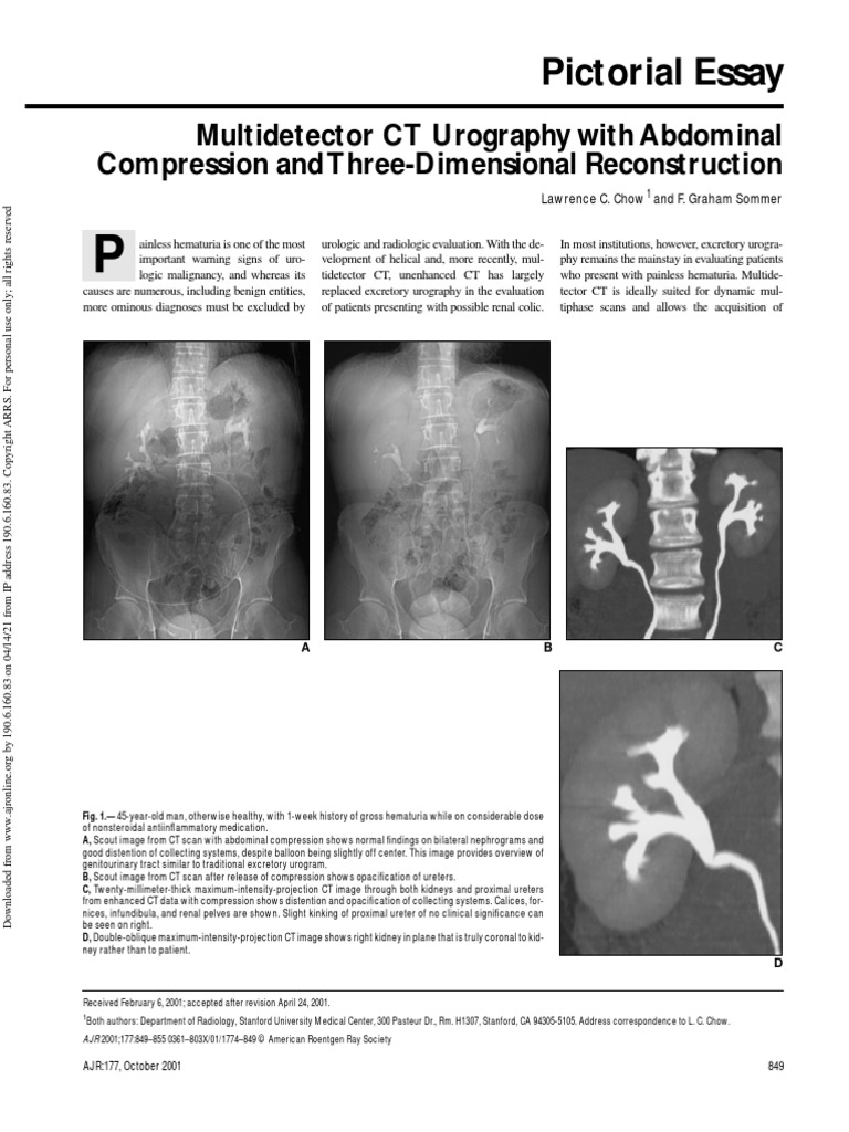Pictorial Essay: Multidetector CT Urography With Abdominal Compression and Three-Dimensional ...